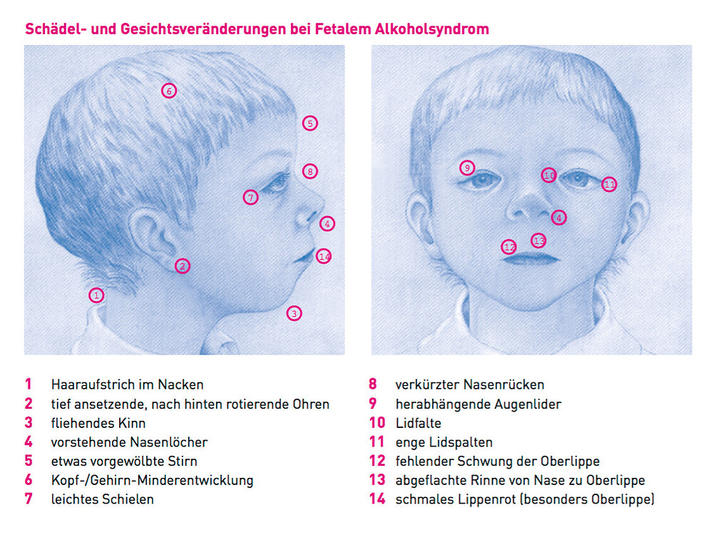 Diagnose Fetales Alkoholsyndrom (FAS) – und nun? - Fachbeiträge ...